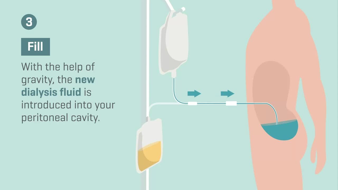 Peritoneal Cavity Continuous Ambulatory Peritoneal Dialysis | My