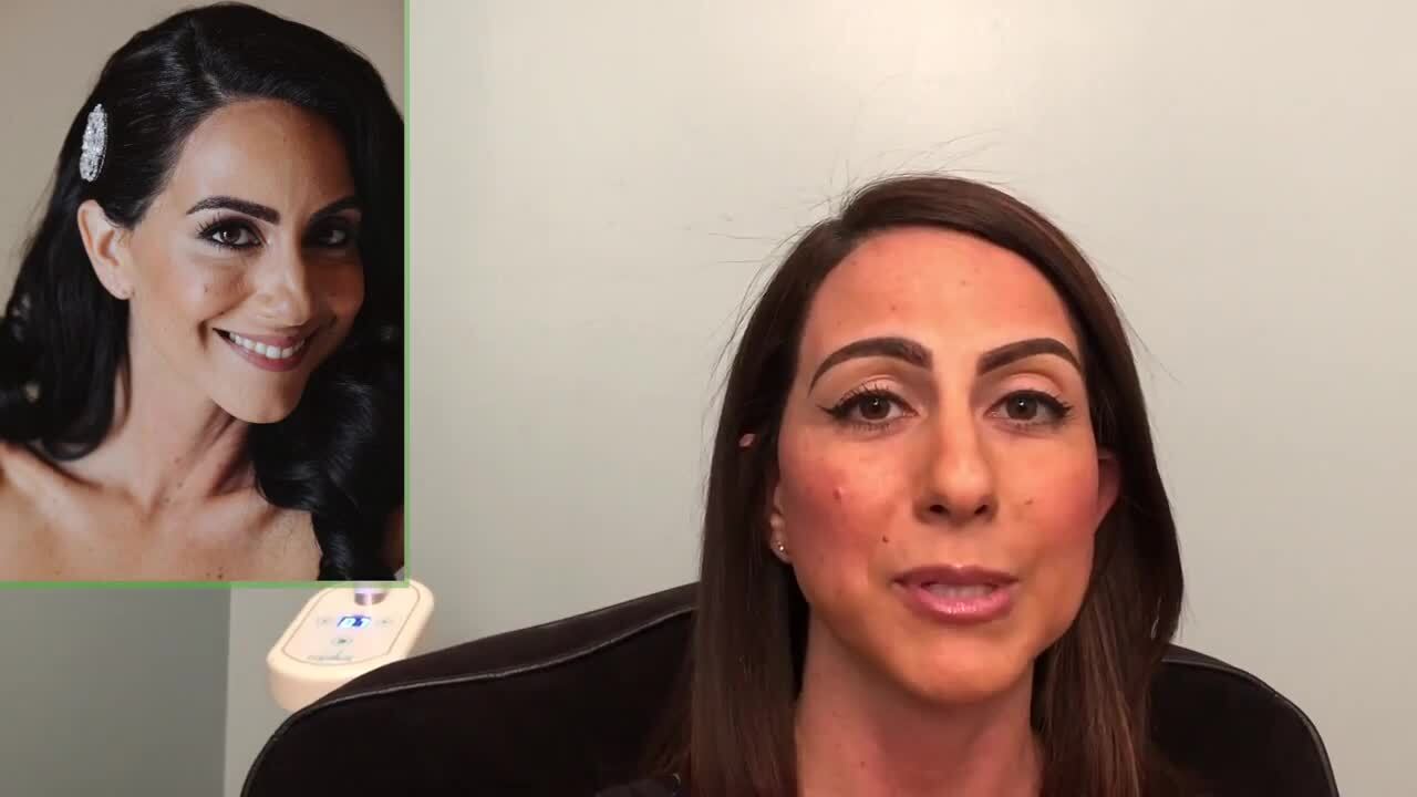 AMAZING Eyebrow Transplant Update - Before and After - Video - RealSelf