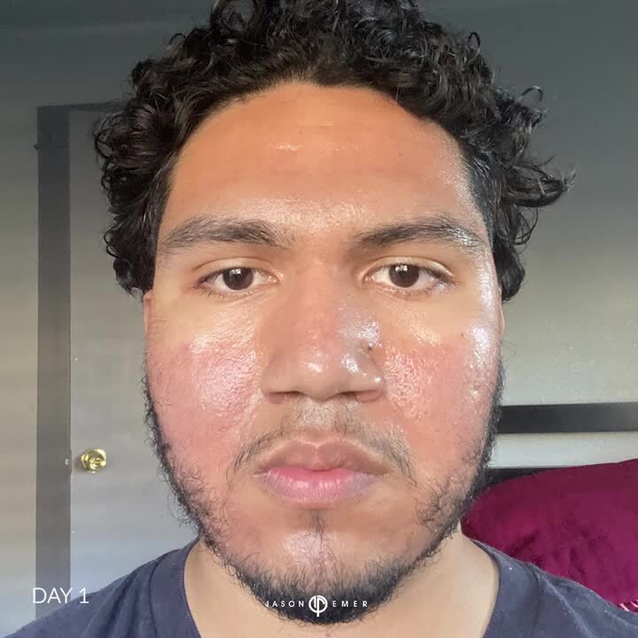 Acne Scar Combination + Illuminating Mask - Video - RealSelf