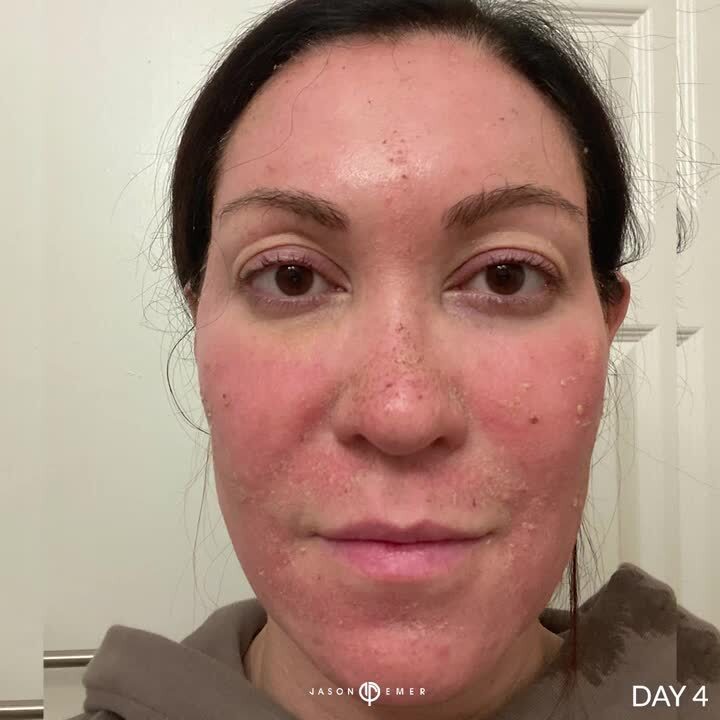 A fresh start without acne scares - Video - RealSelf