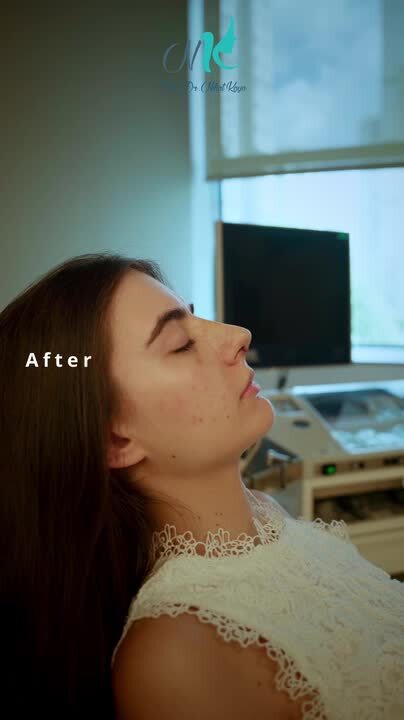 Rhinoplasty using piezo technology - Video - RealSelf