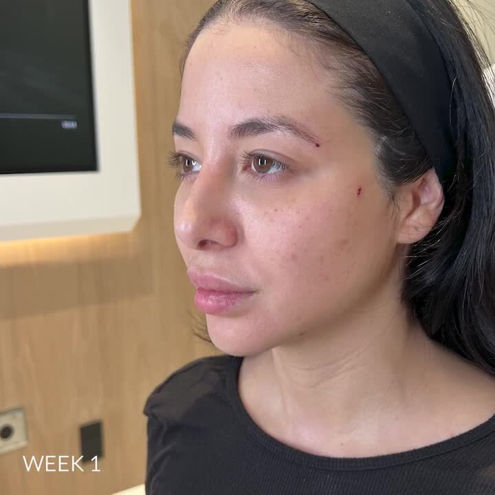 VERTICAL ENHANCED WITH PDO MAX - Video - RealSelf