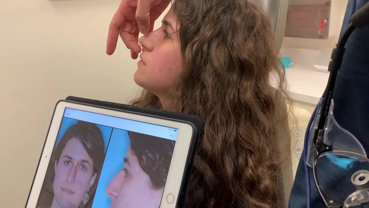 Shortening the long nose in rhinoplasty I Anthony Bared , MD, FACS I ...