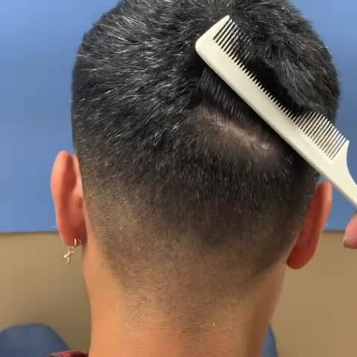 FUT Hairtransplant using trichophytic closure - Video - RealSelf