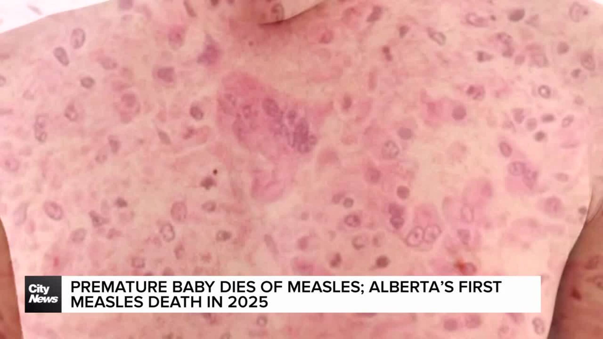 Premature baby dies of measles; Alberta’s first measles death in 2025