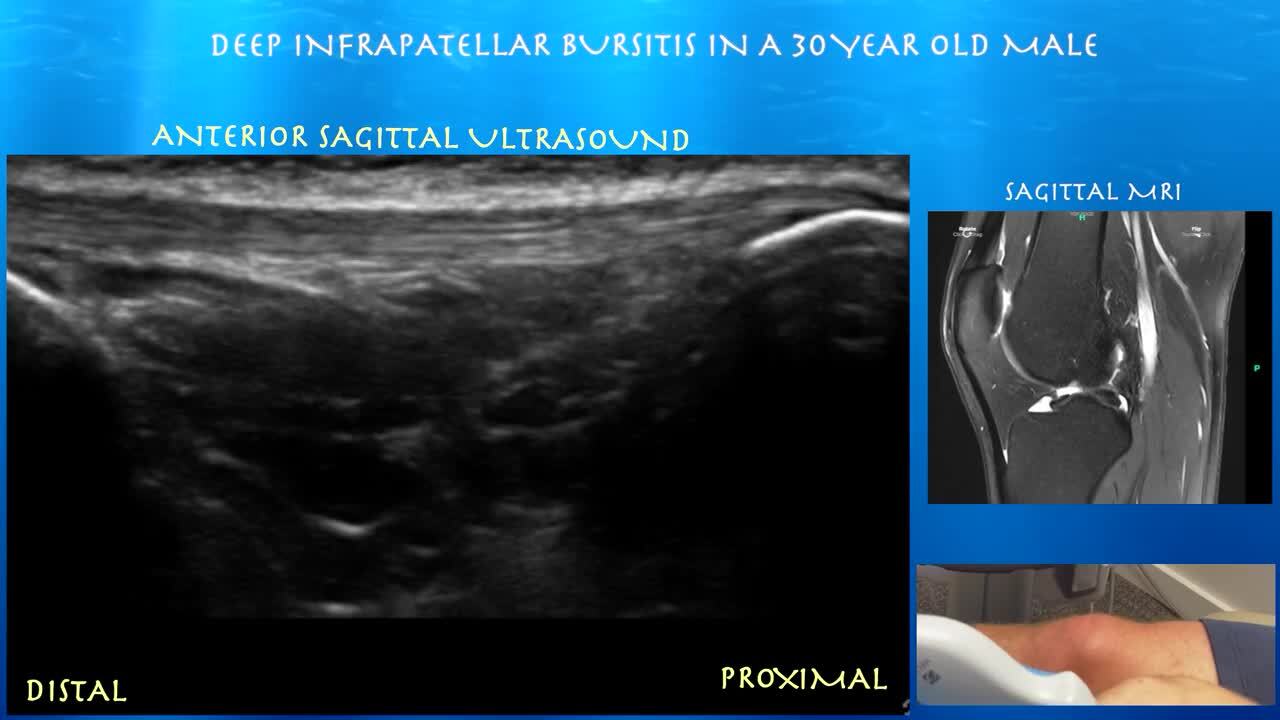 Prepatellar Bursitis Ultrasound