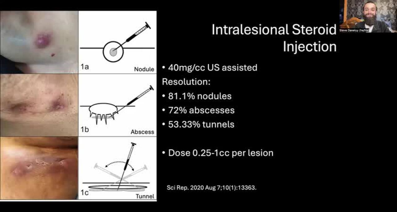 Intralesional Injections
