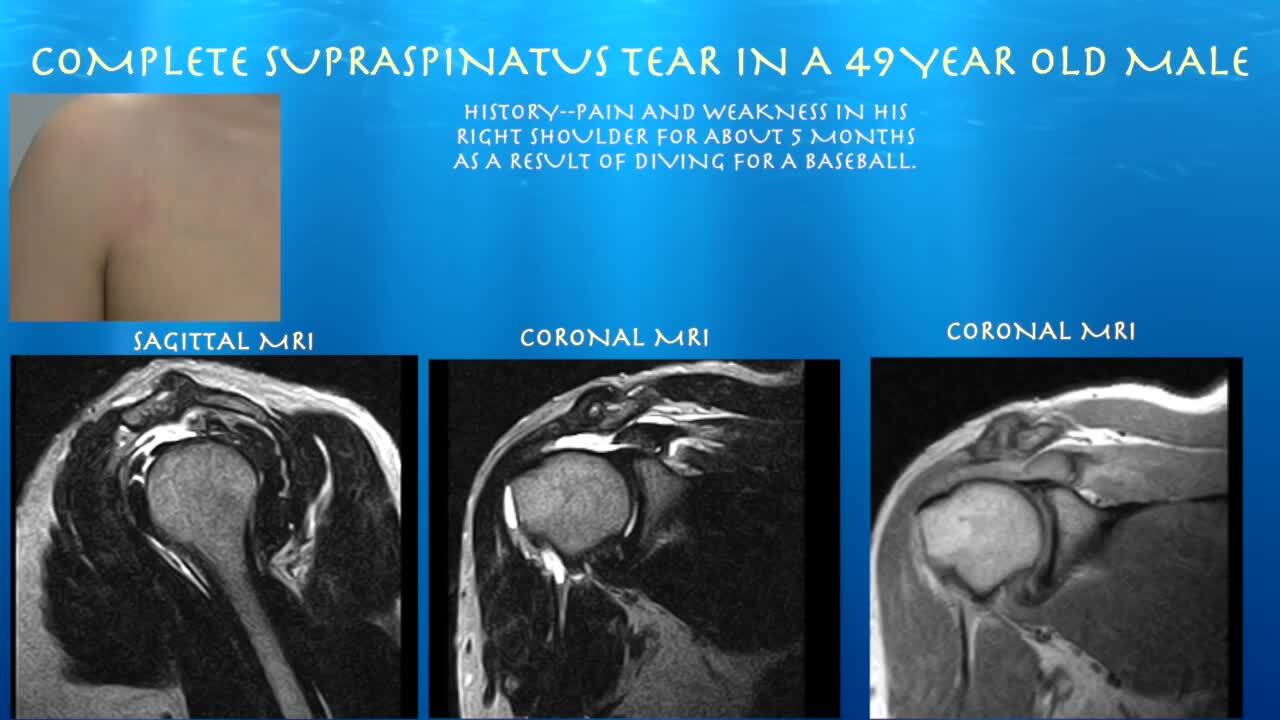 Supraspinatus Tear