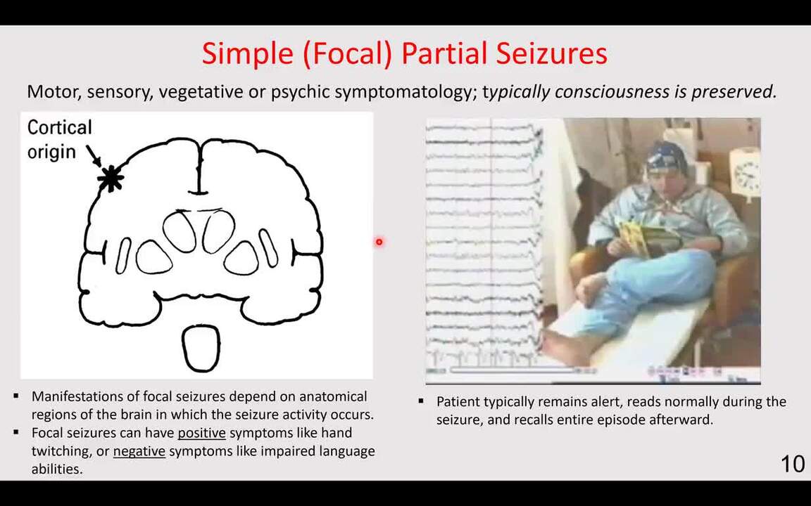 Partial Seizures