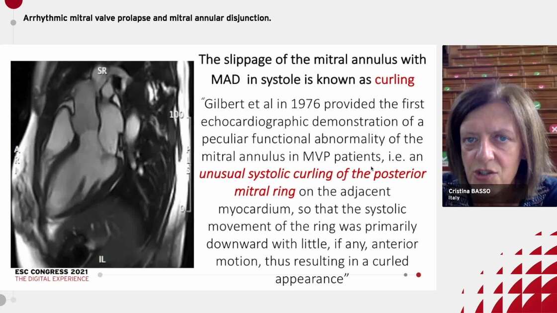 ESC 365 - Arrhythmic mitral valve prolapse and mitral annular disjunction.