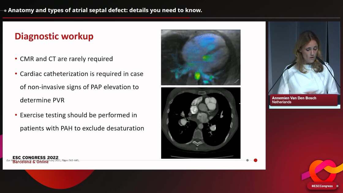 ESC 365 - Anatomy and types of atrial septal defect: details you need ...