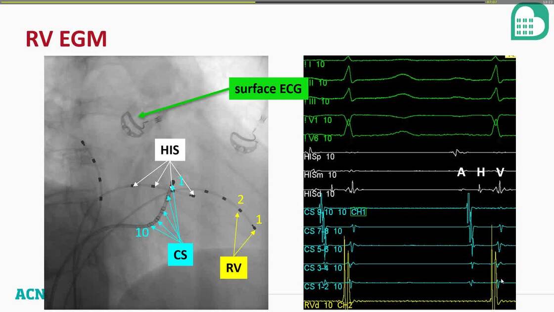 ESC 365 - The basics of EP in the cath lab focus on tools used