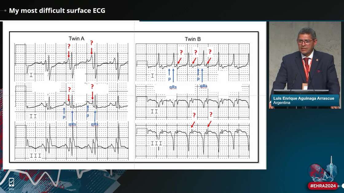 ESC 365 - My most difficult surface ECG