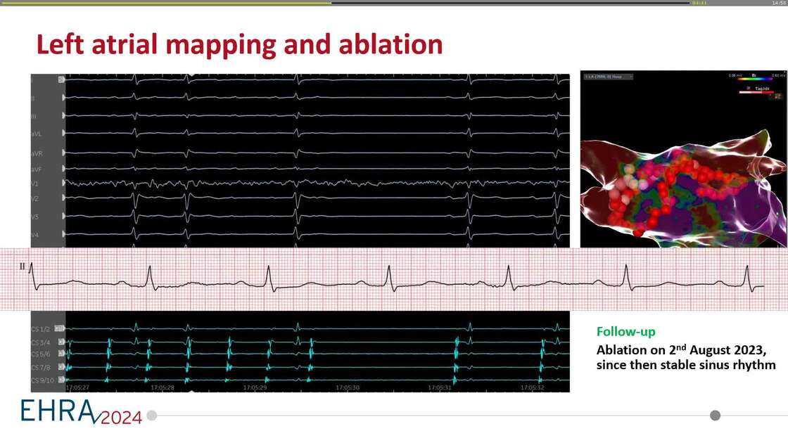 ESC 365 - Successful ablation of left atrial macroreentrant tachycardia through an implanted ...