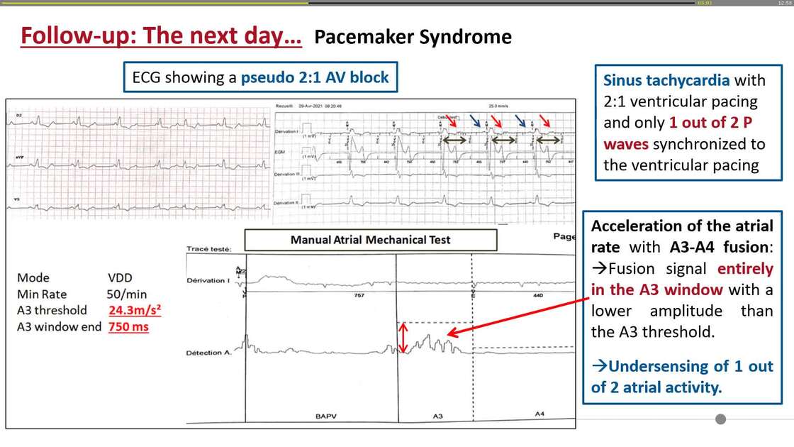 ESC 365 - MICRA AV leadless system pacing: what a challenge for a new ...