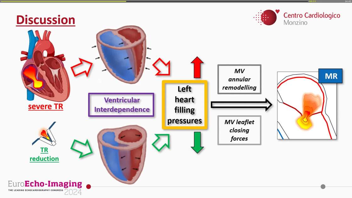 ESC 365 - Mitral regurgitation evolution after transcatheter tricuspid ...