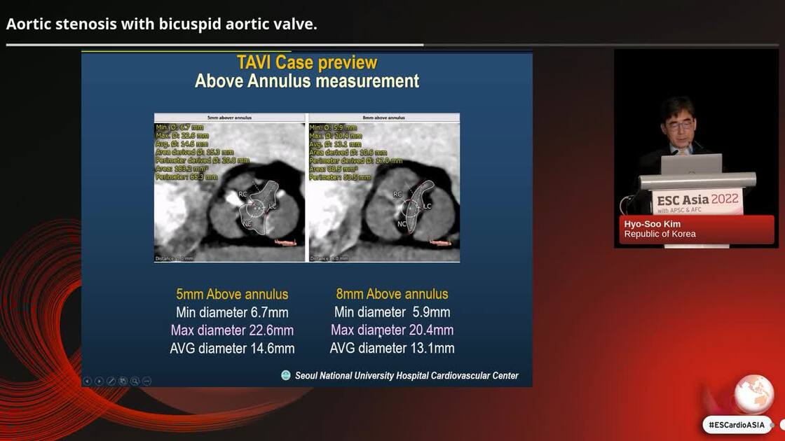 ESC 365 - Aortic stenosis with bicuspid aortic valve.