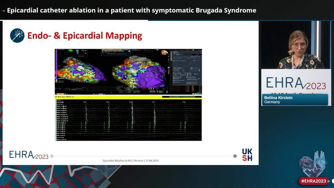 ESC 365 - Epicardial catheter ablation in a patient with symptomatic Brugada Syndrome