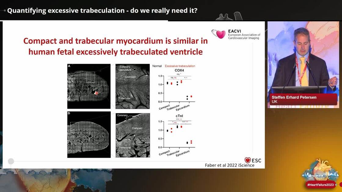 ESC 365 - Quantifying excessive trabeculation - do we really need it?