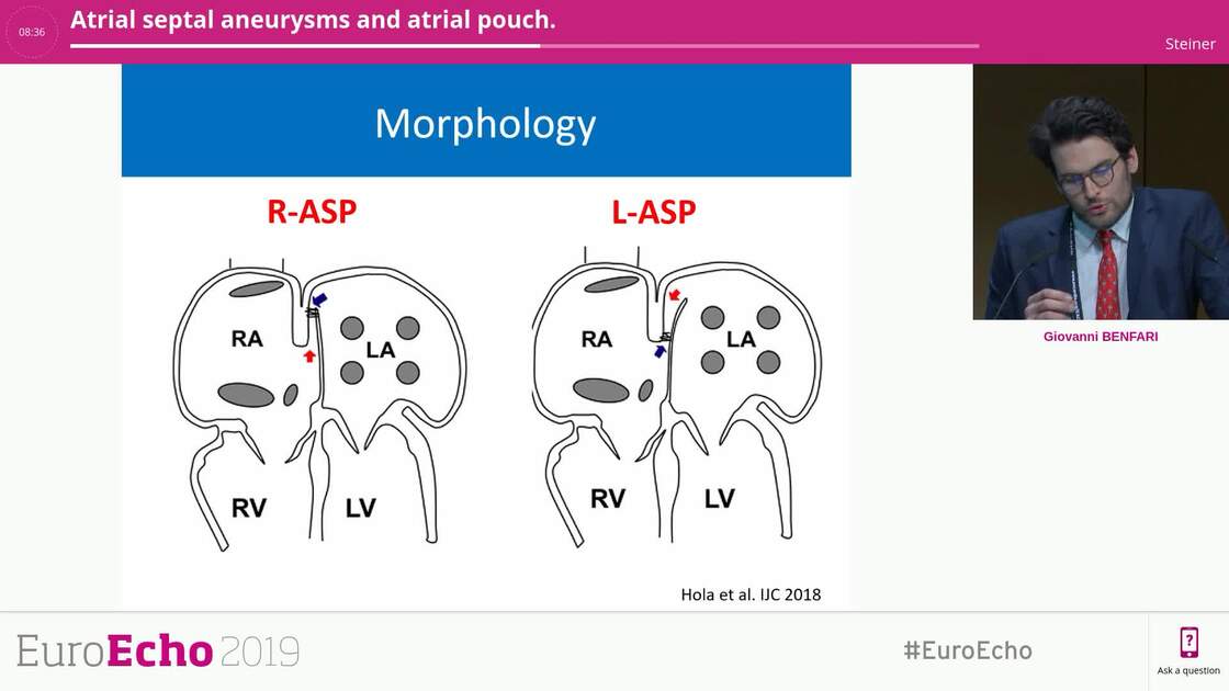 ESC 365 - Atrial septal aneurysms and atrial pouch.