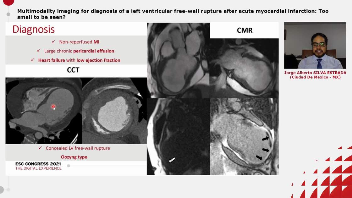 ESC 365 - Multimodality imaging for diagnosis of a left ventricular ...
