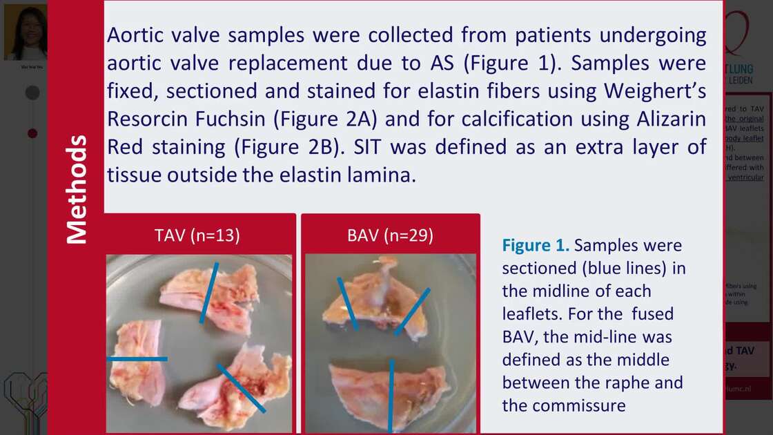 ESC 365 - Differences between stenotic bicuspid and tricuspid aortic ...