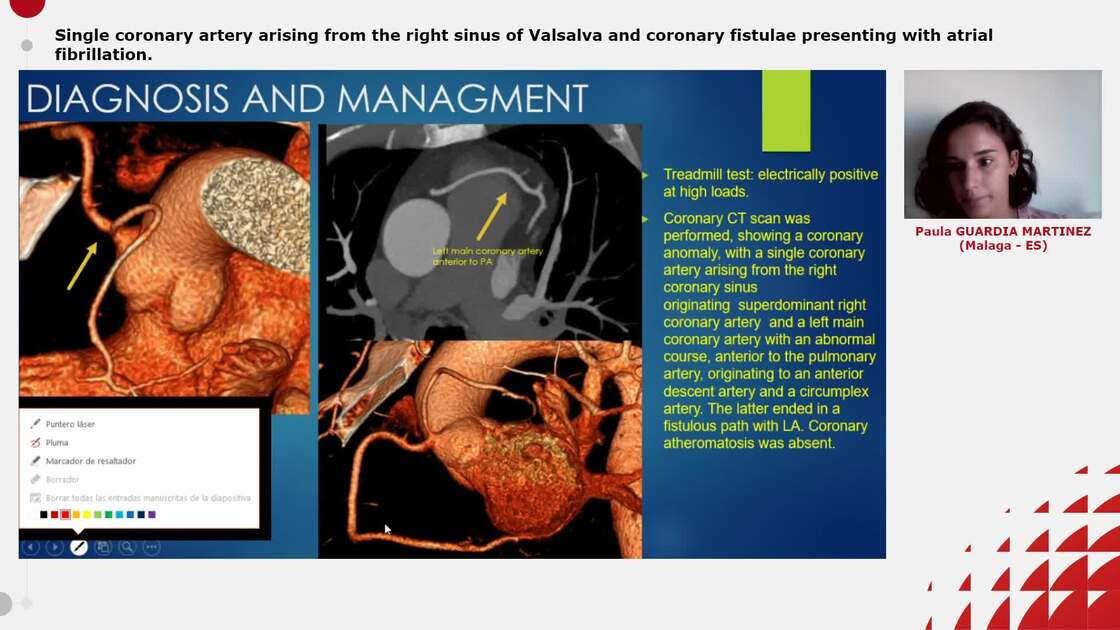ESC 365 - Single coronary artery arising from the right sinus of ...