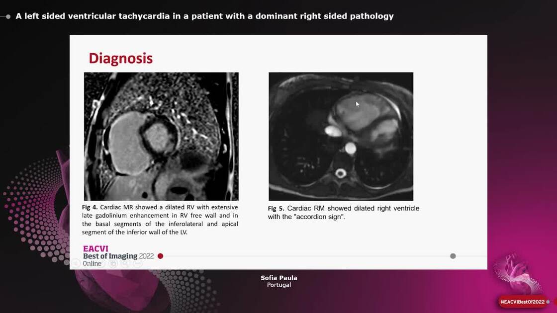 ESC 365 - A left sided ventricular tachycardia in a patient with a ...