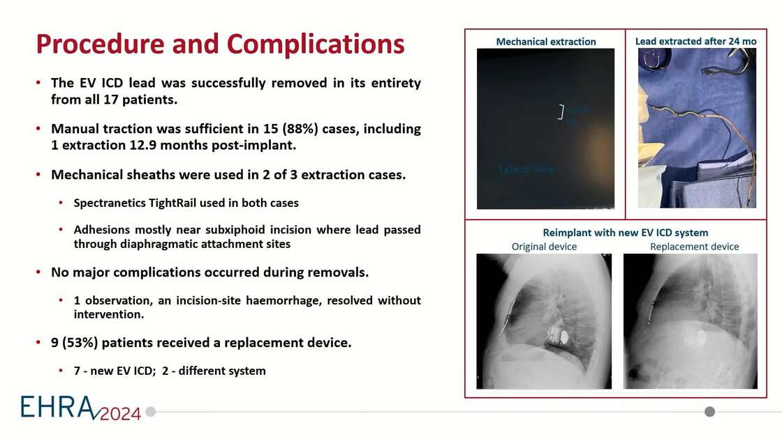 ESC 365 - Substernal lead removal: experience from the EV ICD pivotal study