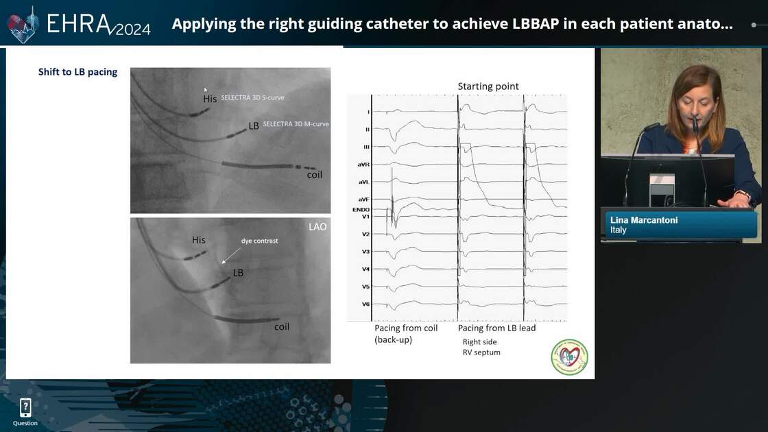 ESC 365 - Applying the right guiding catheter to achieve LBBAP in each ...