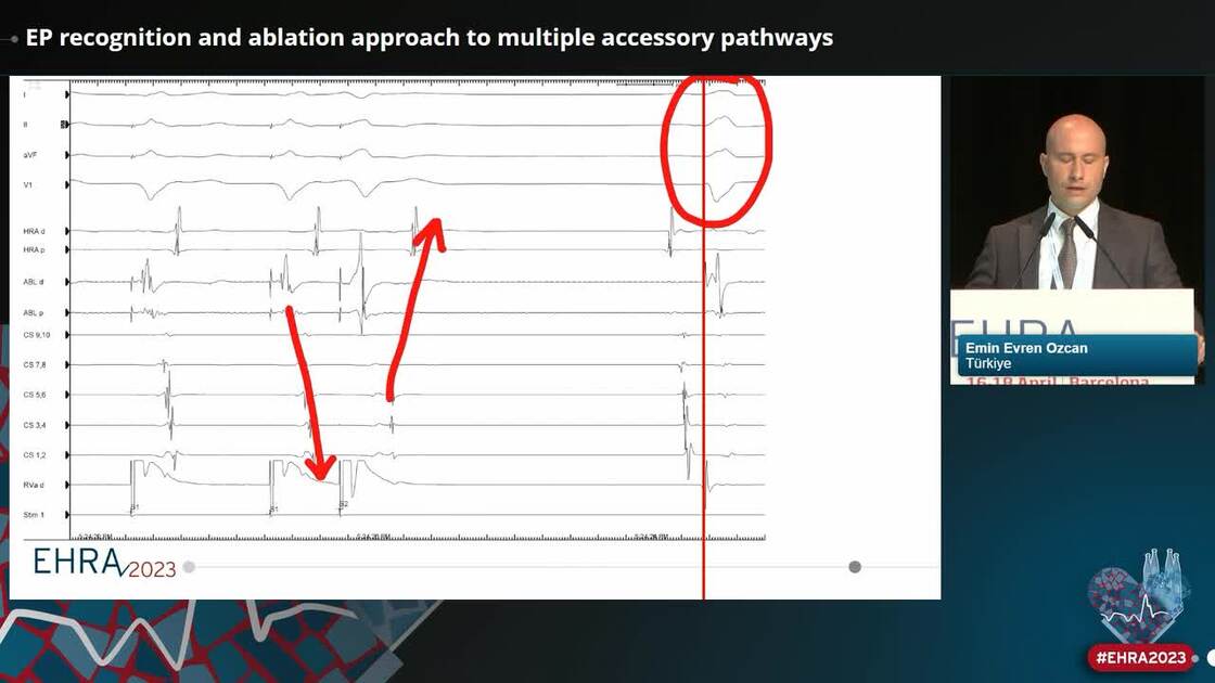 ESC 365 - EP recognition and ablation approach to multiple accessory ...