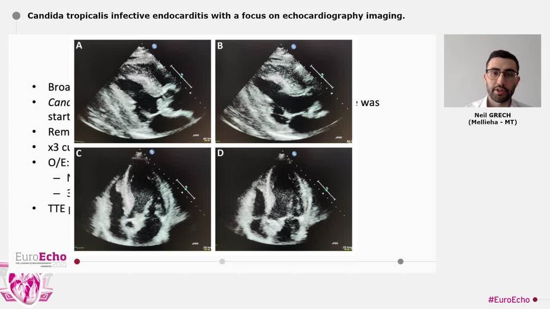 ESC 365 - Candida tropicalis infective endocarditis with a focus on ...