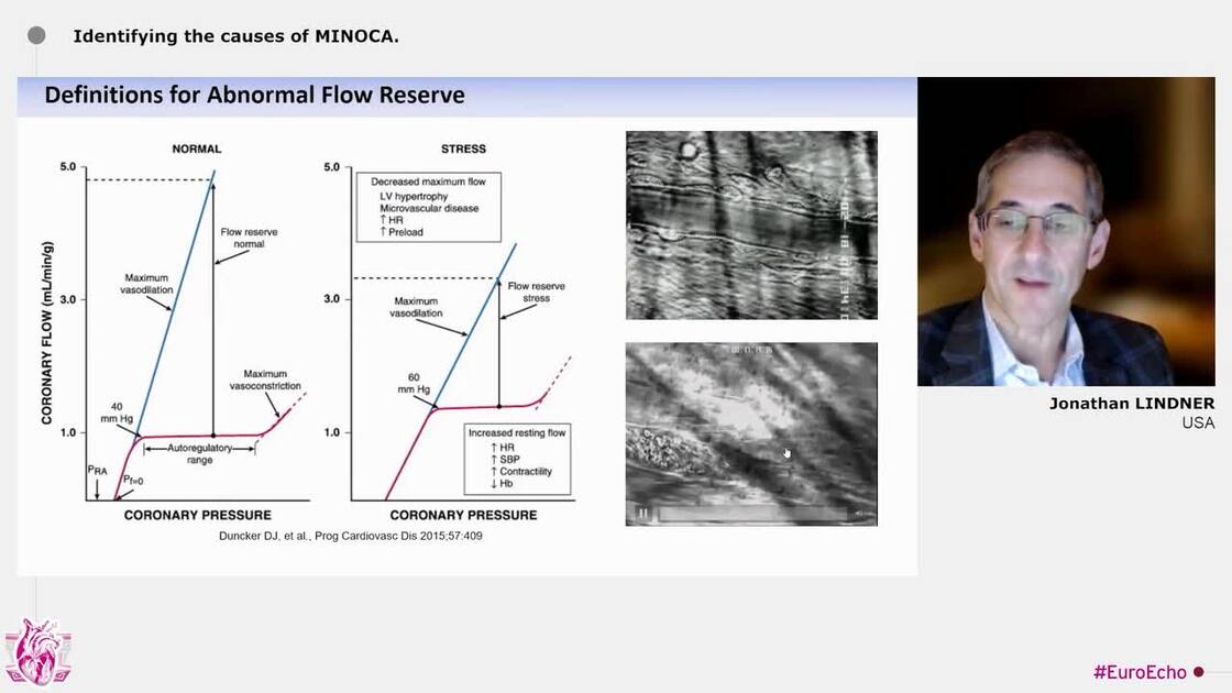 ESC 365 - Identifying the causes of MINOCA.
