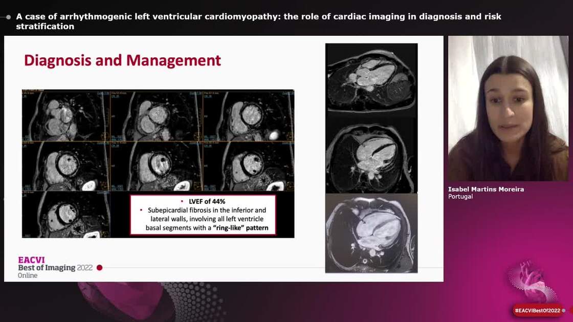ESC 365 - A case of arrhythmogenic left ventricular cardiomyopathy: the ...
