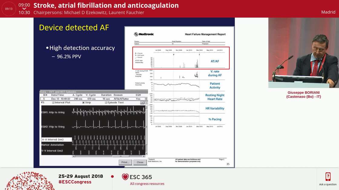 ESC 365 - Diagnosing atrial fibrillation and the risk of stroke - Do 30 seconds of arrhythmia ...
