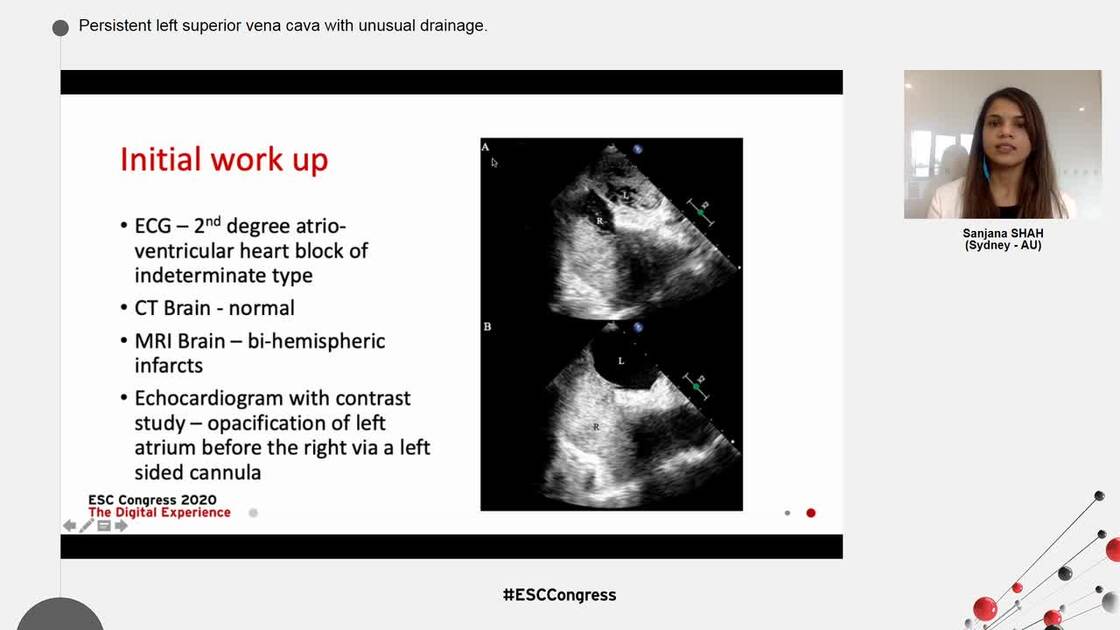ESC 365 - Persistent left superior vena cava with unusual drainage.