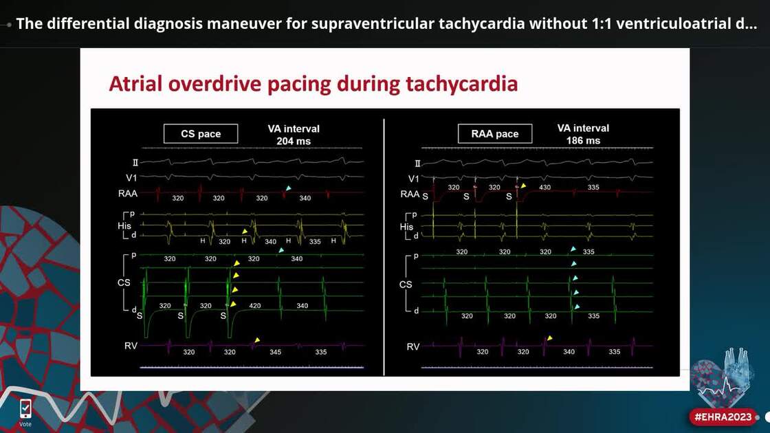 ESC 365 - The differential diagnosis maneuver for supraventricular ...
