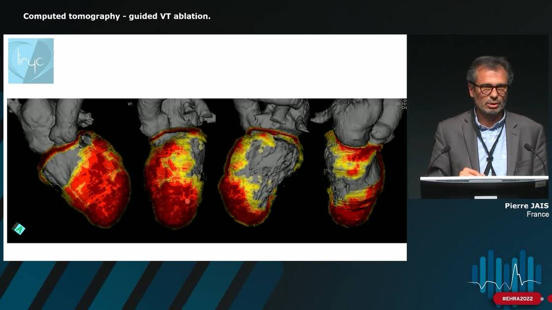 ESC 365 - Computed tomography - guided VT ablation.