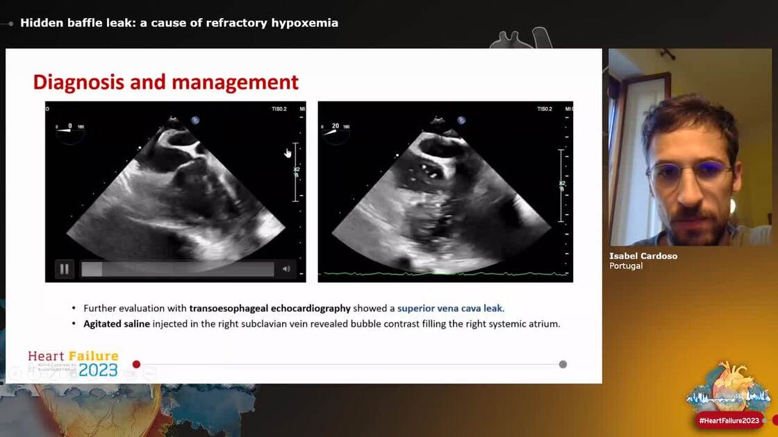 ESC 365 - Hidden baffle leak: a cause of refractory hypoxemia