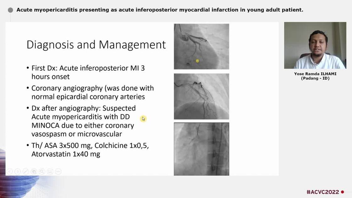 ESC 365 - Acute myopericarditis presenting as acute inferoposterior ...