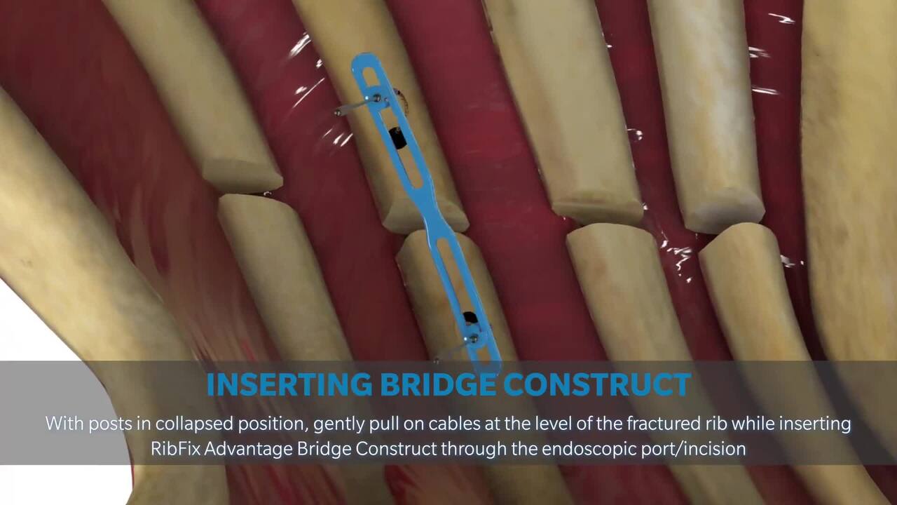 RibFix Advantage® | Zimmer Biomet | Zimmer Biomet