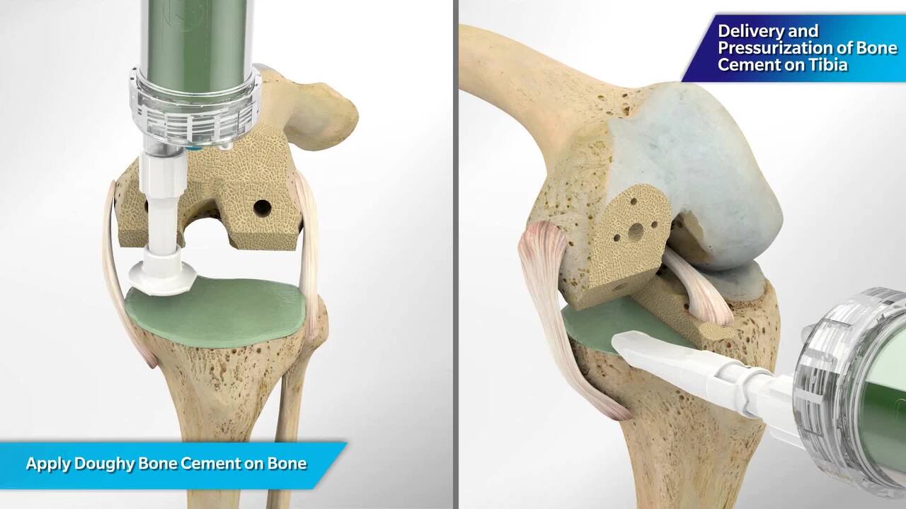 Optipac Vacuum Mixing System | Zimmer Biomet | Zimmer Biomet