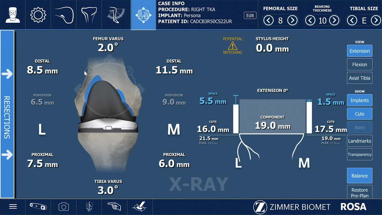 ROSA Knee System | Zimmer Biomet | Zimmer Biomet