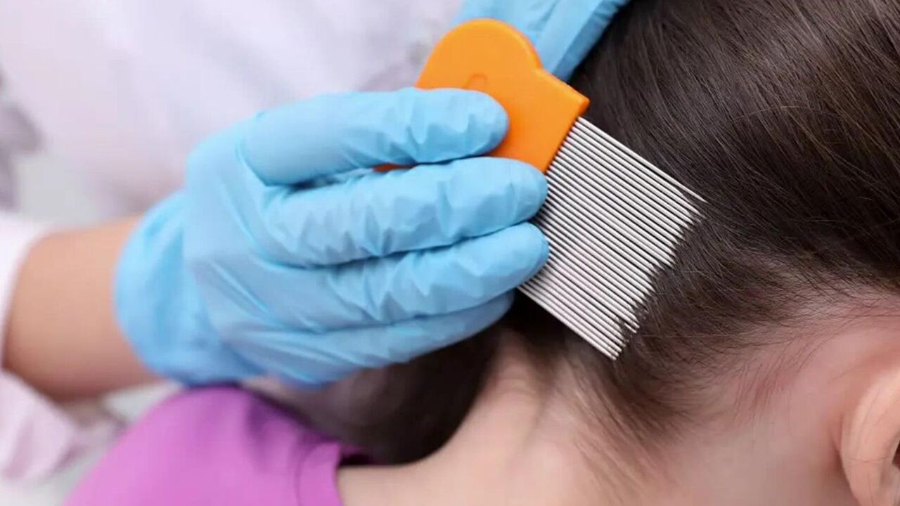 ‘super Lice Is On The Rise — Heres How To Treat It At Home