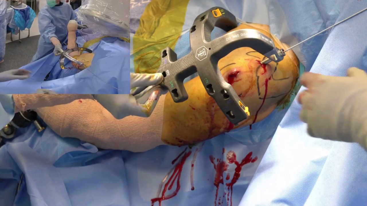 08.22.24-EST-Video-Intramedullary Nailing Technique for Proximal ...