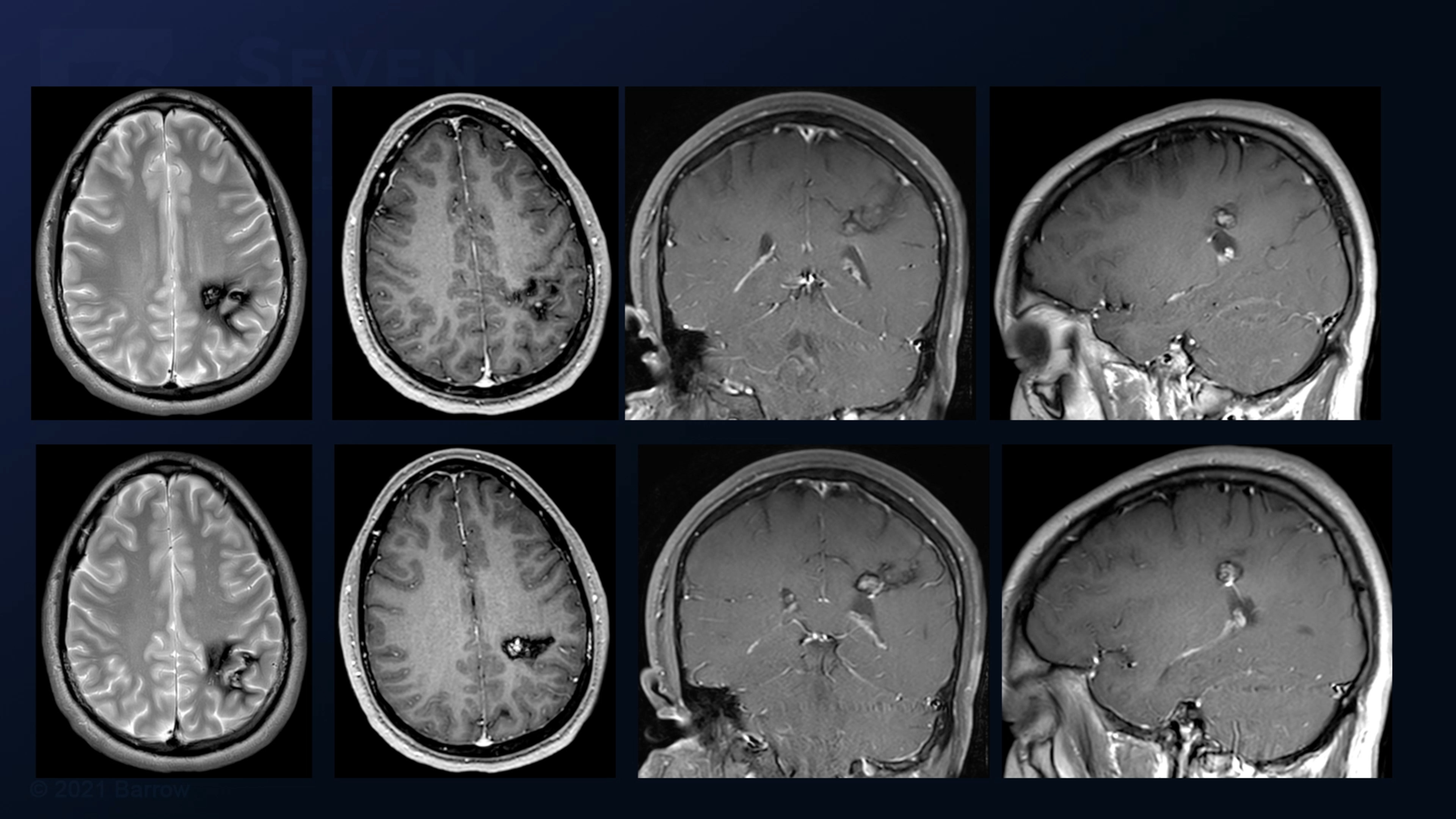 #120 Midline Supracerebellar-Infratentorial Approach with Clip ...