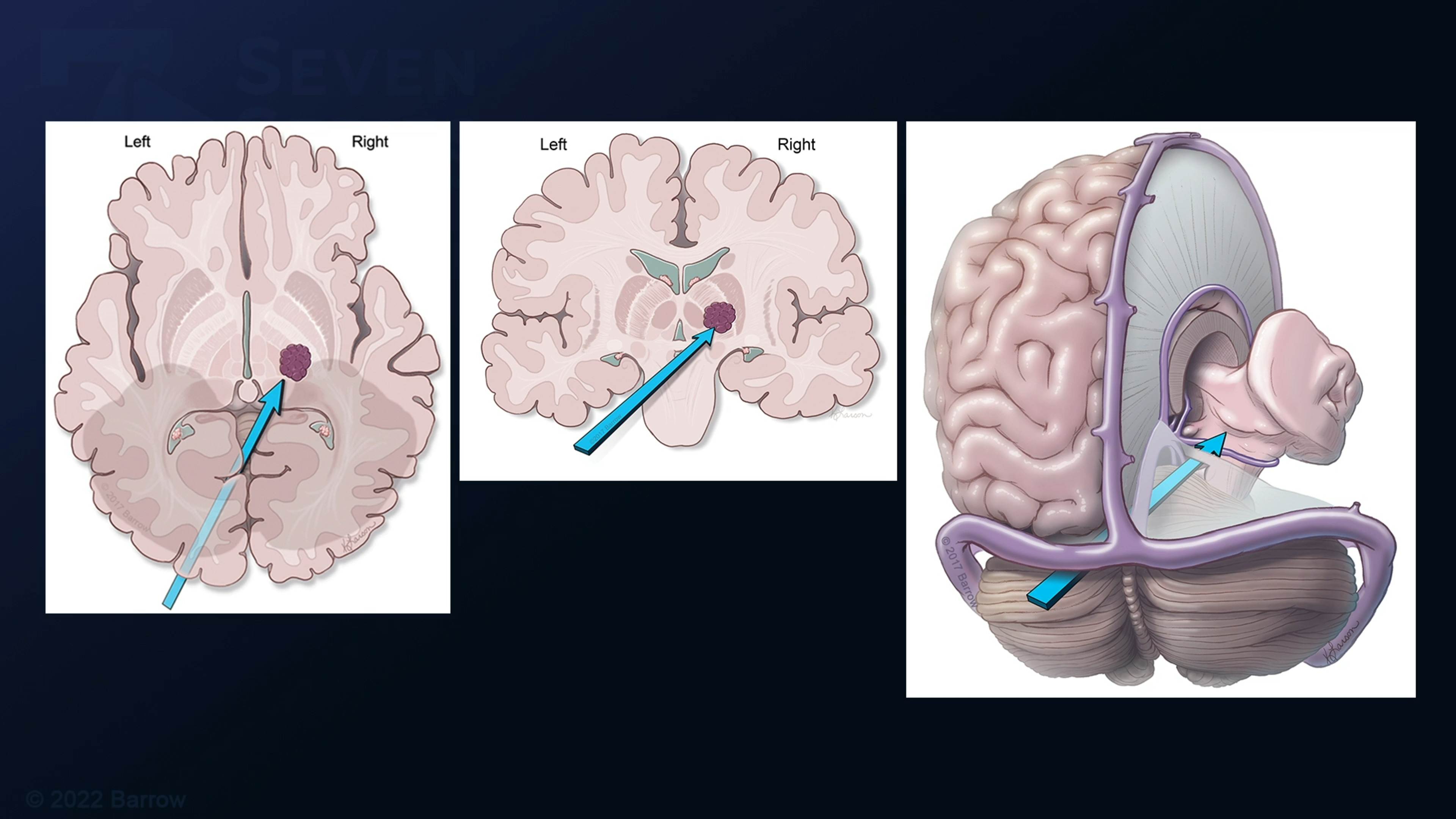 #210: Transsylvian-Transinsular Approach for Resection of a Posterior ...