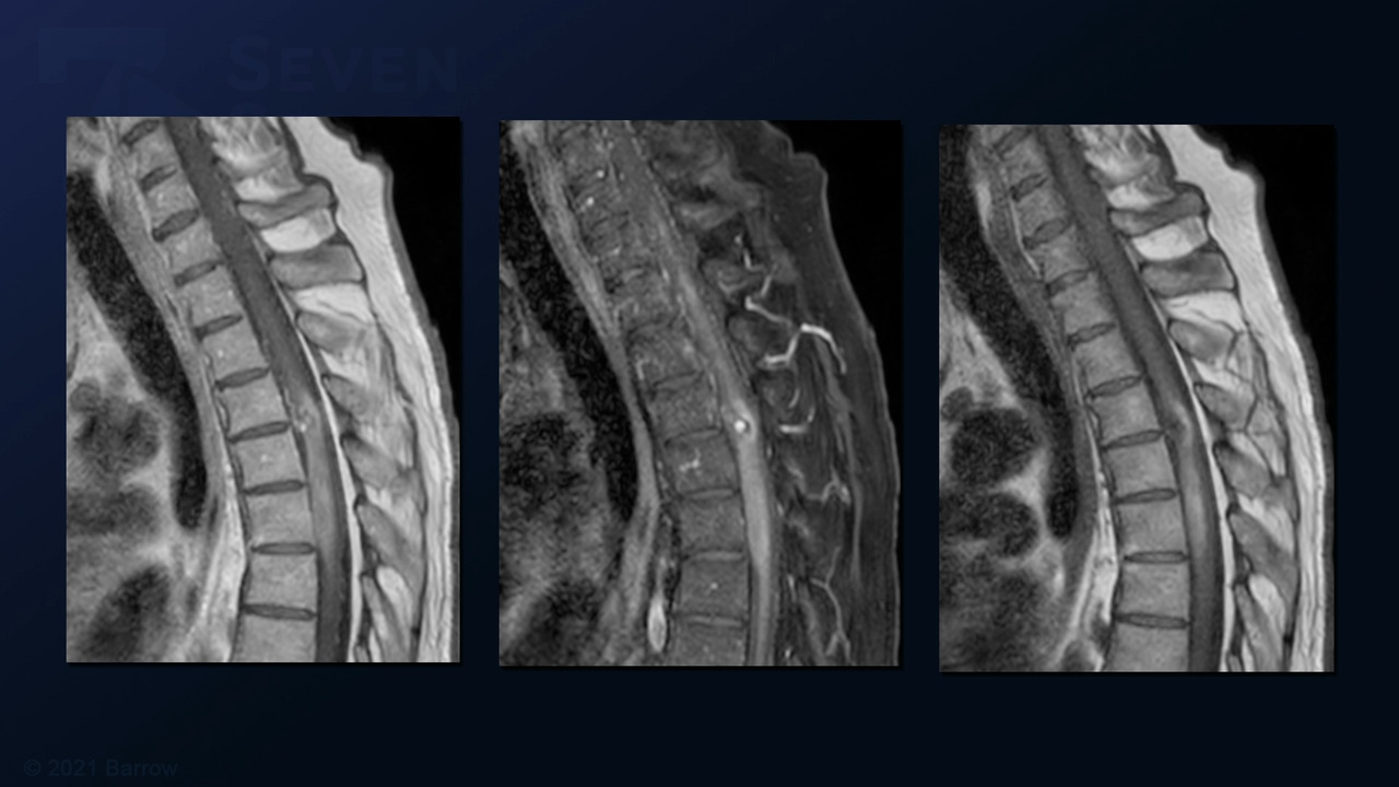 Arteriovenous Malformation - Seven Series Collection