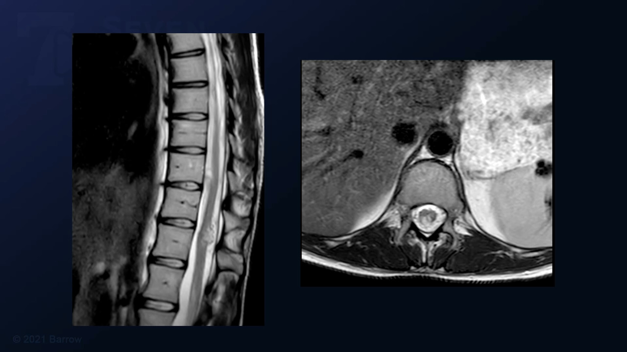 #74: Suboccipital Craniotomy with C1 Laminectomy for Resection of a ...
