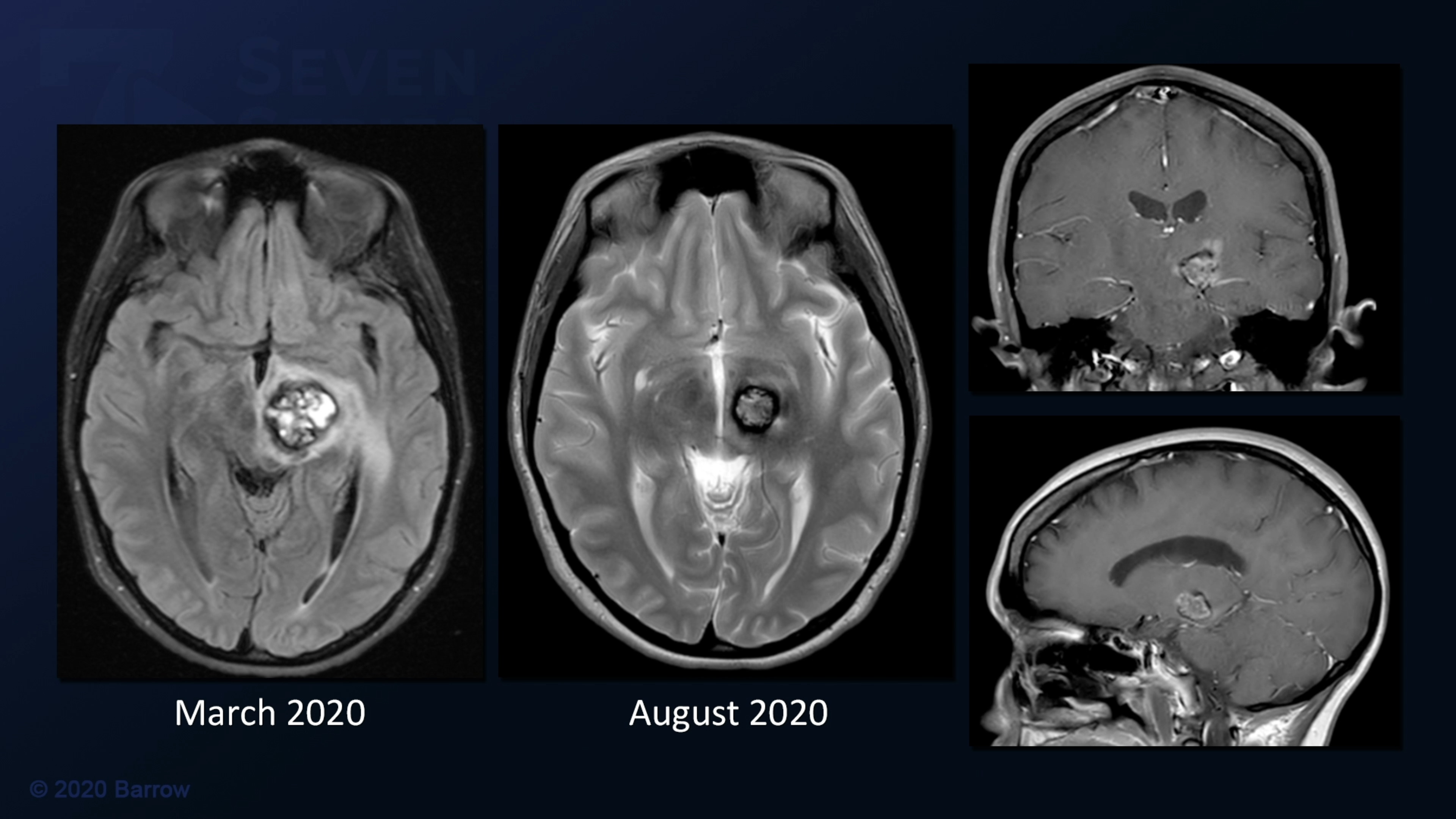 #97: Supracerebellar-Transtentorial Approach for Resection of a Left ...